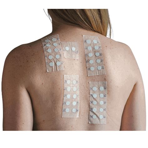 Skin Allergy Patch Test Allergy Skin Testing