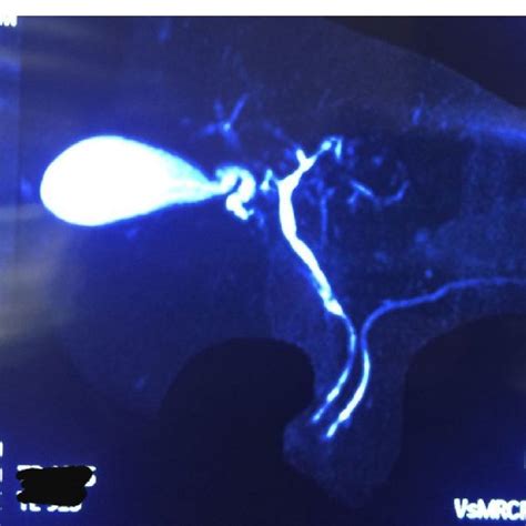 Second Mrcp Of The Patient After 6 Months Download Scientific Diagram