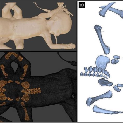 bone segmentation using 3d slicer download scientific diagram