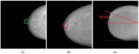 Automated Assessment Of Breast Positioning Quality In Screening