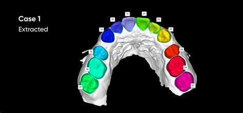 case 1 upper teeth scan with every tooth in different color and number