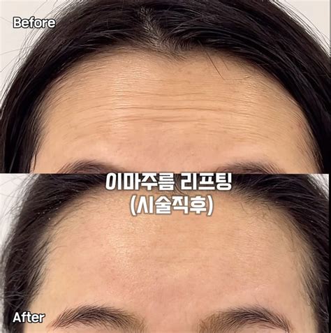 구미피부관리ㅣ구미플라즈마ㅣ구미다이어트 온나로뷰티 교육기관 처진 눈꺼풀 개선입니다 수술 피플라즈마 리프팅⭕️ 주피플라 본점 ️머리부터 발끝까지 모든 피부에 접목