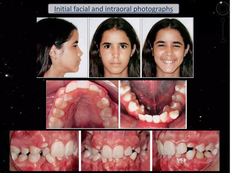 Class Ii Div 2 Malocclusion Pptx