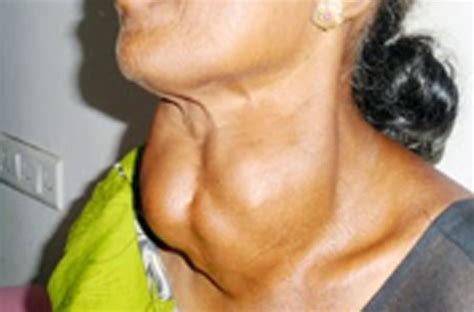 Multinodular Thyroid