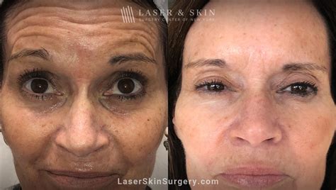 How To Correct Botched Botox Dermatology Experts Explain Laser Ny
