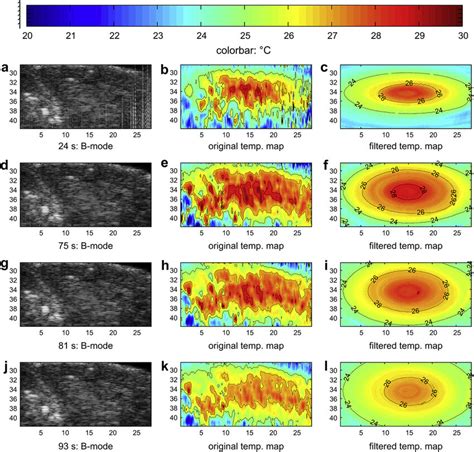 The Results Of The Unfiltered And Filtered Adaptive Kalman Filtering Download Scientific