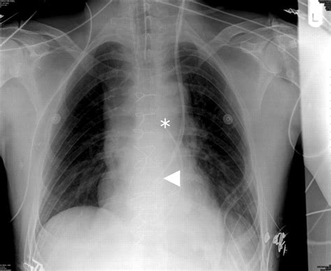 Cannulation Of A Persistent Left Superior Vena Cava Circulation My Xxx Hot Girl