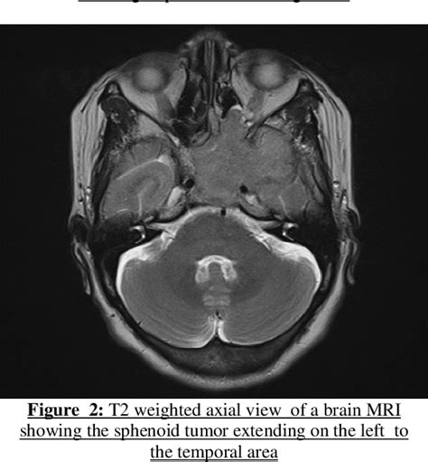 Figure 2 From Clinical Case Multiple Myeloma Revealed By A Sphenoid Plasmocytoma A Case Report