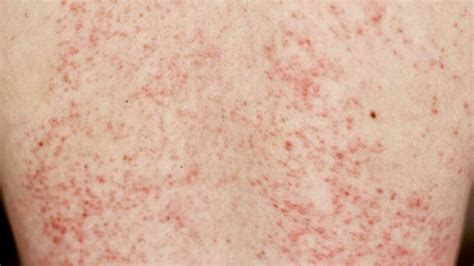 What Does A Strep Rash Look Like Torrinomedica What Does A Strep Rash Look Like Torrinomedica