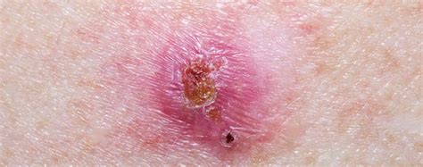 Quest Ce Quun Carcinome Basocellulaire Infiltrant Chirurgie Dermatologique Paris Monceau