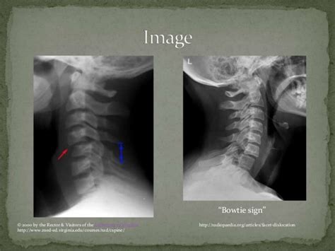 Unilateral Facet Dislocation