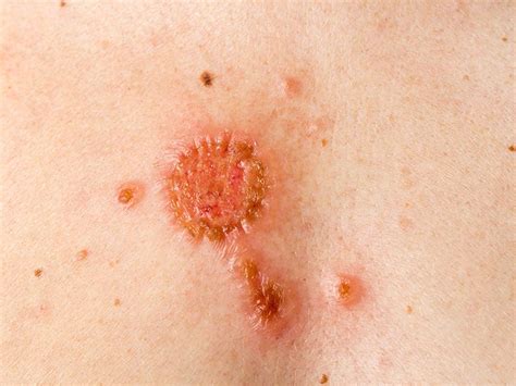 Squamous Cell Carcinoma Stratum Dermatology Clinics