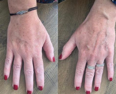 Profhilo Treatment London Free Consultation Prices From £295