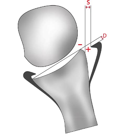Dislocation D And Separation S Of The Labrum In Relation To The Download Scientific Diagram