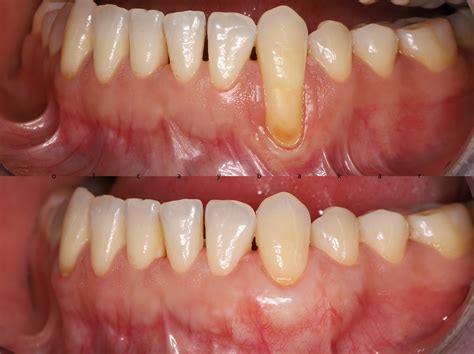 Drolcay Bakar Interproximal Bone Loss Papilla Loss And Gingival