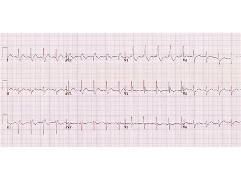 Bifasicular Block Ecg 2019 Ppt