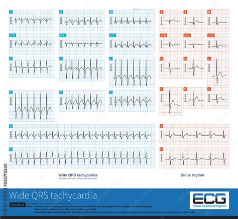Poster If There Is Basic Intraventricular Conduction Disorder In Sinus