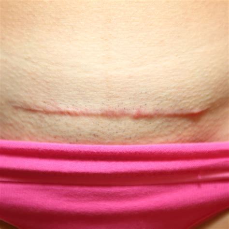 C Section Scar Before And After At Francine Rice Blog