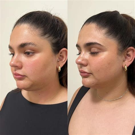 Hifu Before And After Photos And Everything You Need To Know