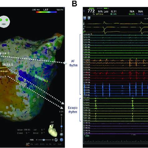 Mixed Feature Of Ectopic Atrial Rhythm And Atrial Fibrillation Af In Download Scientific
