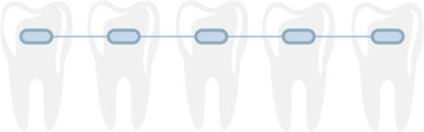 Braces Pngs For Free Download
