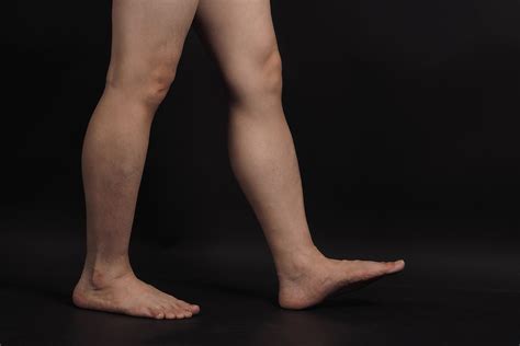 Managing Sacroiliitis With Gait Analysis Custom Orthoses And Physical