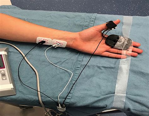 Avoiding Postoperative Residual Weakness—a Cornerstone Of Any Eras Protocol Anesthesia Patient