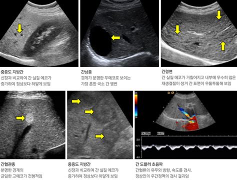 간초음파로 간질환 미리미리예방하세요 네이버 블로그