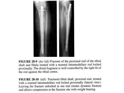 Tibial Shaft Fractures Rehabilitation Pptx
