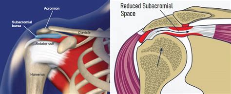 Sub Acromal Decompression Dr Sarang Patki