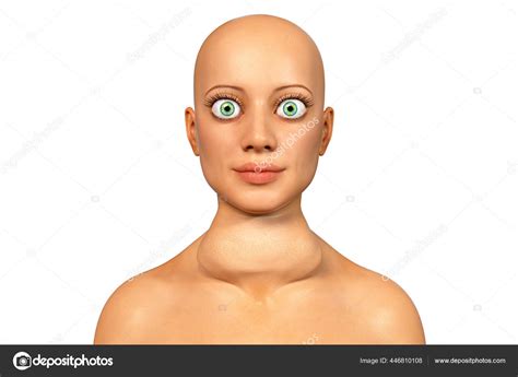 Hyperthyroidism Face