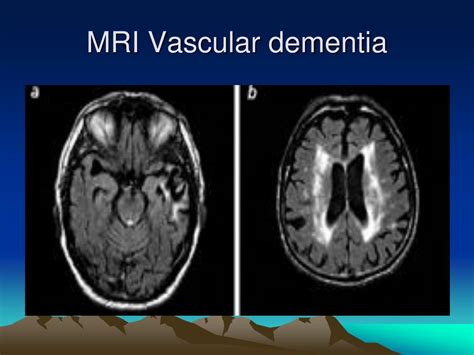 Ppt Dementia Powerpoint Presentation Free Download Id 5629552