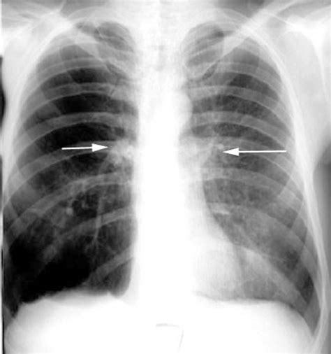 Lung Hyperlucent Macleod Syndrome Swyer James Syndrome Thorax Hyperlucent