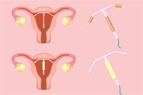 Comparing Hormonal And Copper Iuds Meril Life