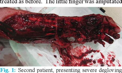 Pdf Degloving Injuries Of Upper Extremity A Strategy With Full