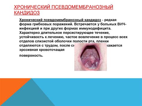 Кандидоз полости рта у детей презентация онлайн