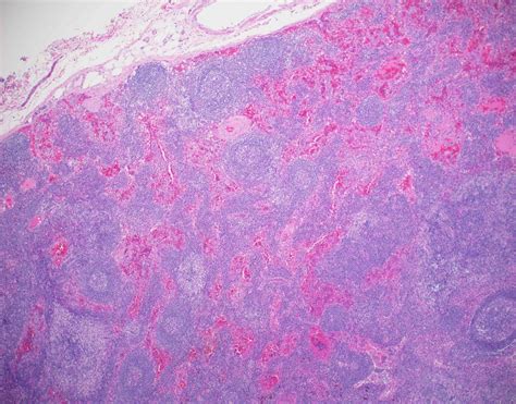 17 Enigmatic Facts About Inguinal Lymph Nodes