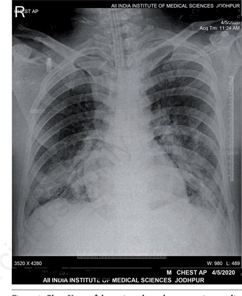 PDF An Unusual Cause Of Tree In Bud Appearance In CT Chest During COVID 19 Pandemic