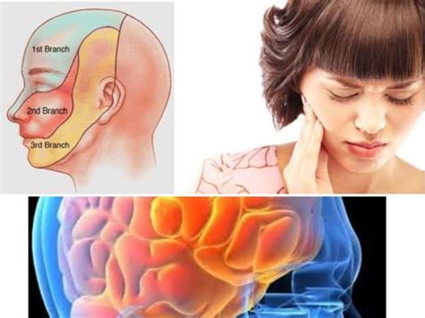 Drug Therapy Of Neuralgias Prof Satyanarayan Pptx