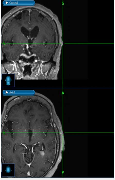 Stereotactic Navigation To Target Craniotomy Around The Sylvian Fissure Download Scientific