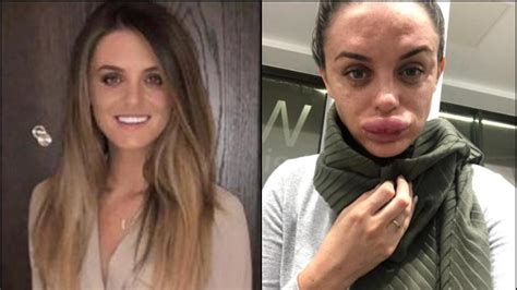 Botox Lips Before And After Pics