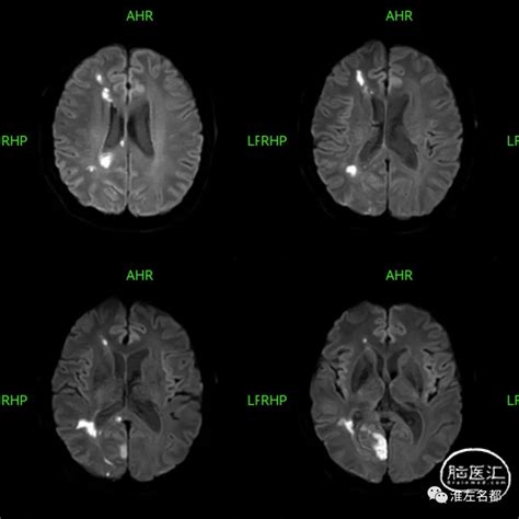 影像读片（44）：颈动脉狭窄血栓脱落经后交通栓塞pca导致颞枕叶大范围梗死 脑医汇 神外资讯 神介资讯