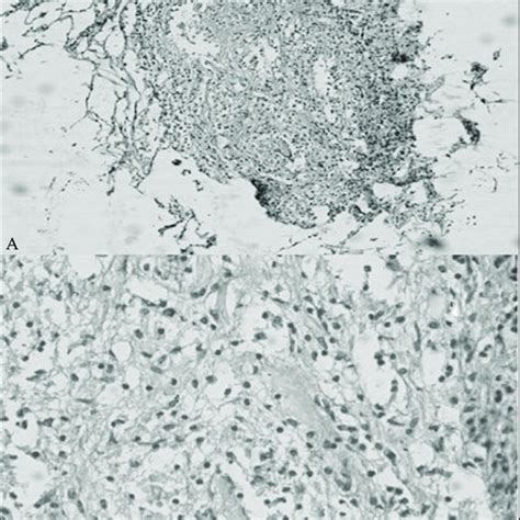 Transbronchial Lung Biopsy Showing Epitheliod Cells Lymphocytes