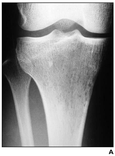 Filediagram Showing Stage 1a Bone Cancer Cruk 198svg Staging Of Bone