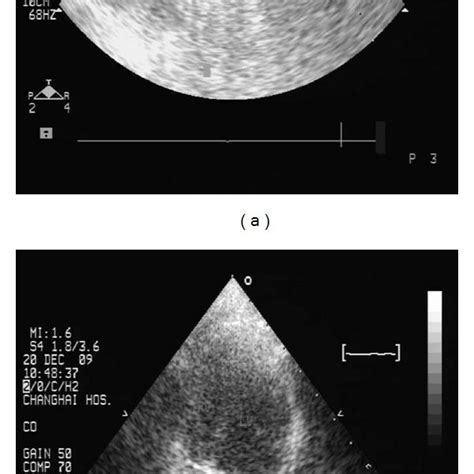 Biodegradable Asd Occluder And Delivery System A Left Atrial View Download Scientific