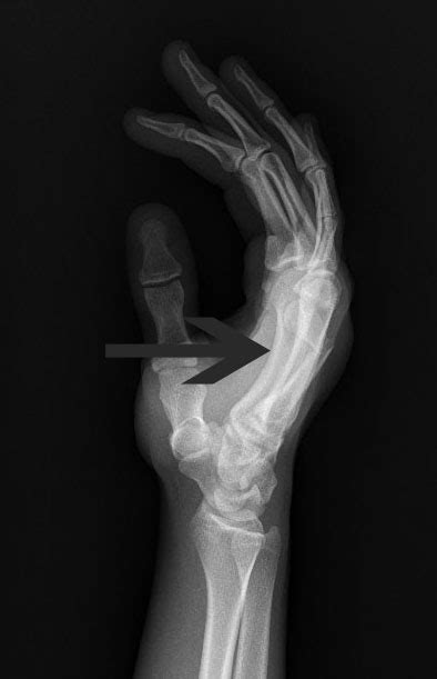 Young Athlete Center Metacarpal Fracture