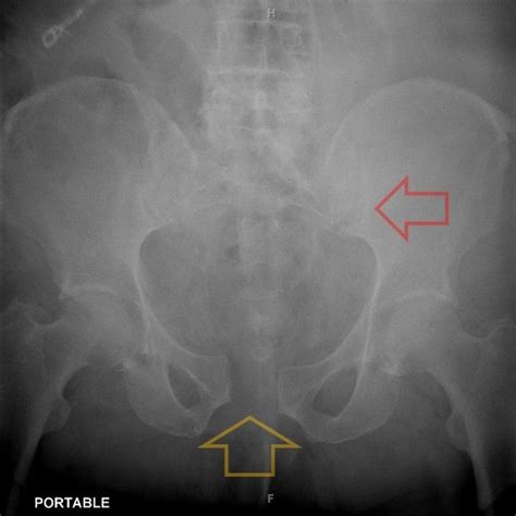 Jointpelvispubic Symphysis Ranzcrpart1 Wiki Fandom Boneclavicle