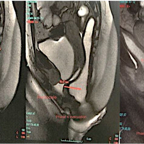 Pubococcygeal Line T2 Weighted Midsagittal Mr Image Of A Female Pelvis Download Scientific