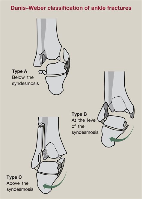 Fractures Of The Foot And Ankle Surgery Oxford International Edition