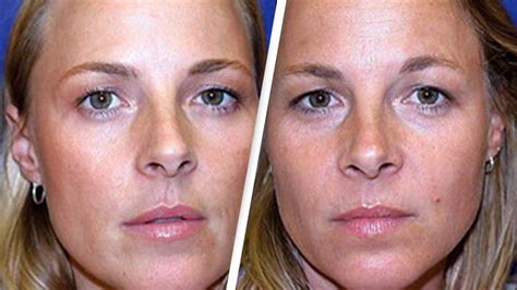 One Twin Had Regular Botox For 19 Years And The Other Didn T And This